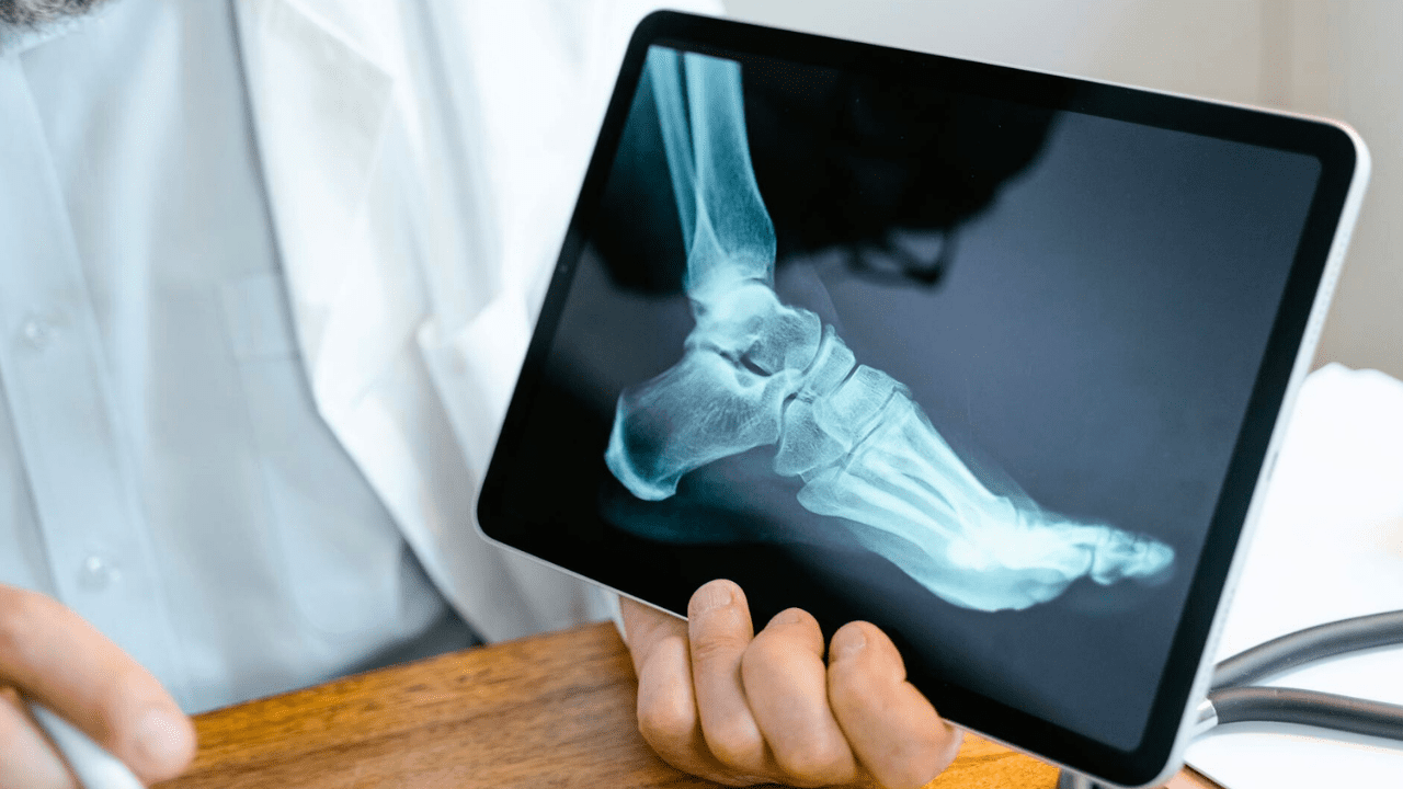 How To Heal A Sprained Ankle Faster? Proven Tips!